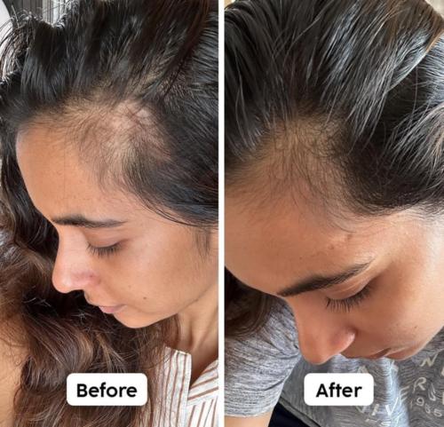 How To Use Red Light Therapy For Hair Growth Before And After | Shelly ...